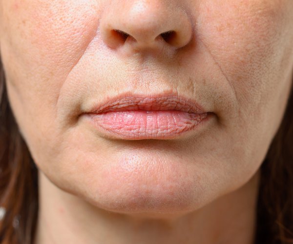 Muttermal entfernen lassen: Kosten & Methoden