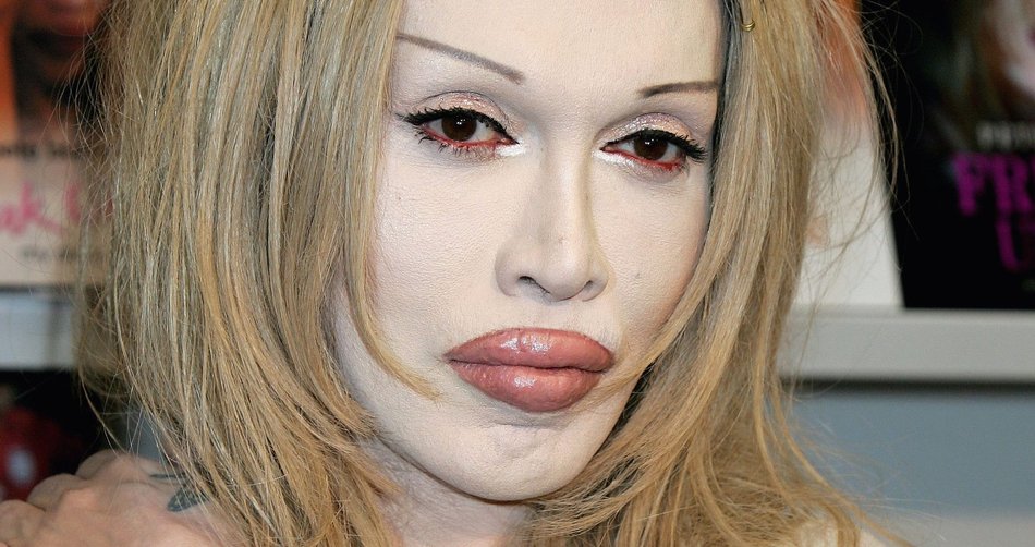 Botox und Co.: Beauty-Fails der Stars