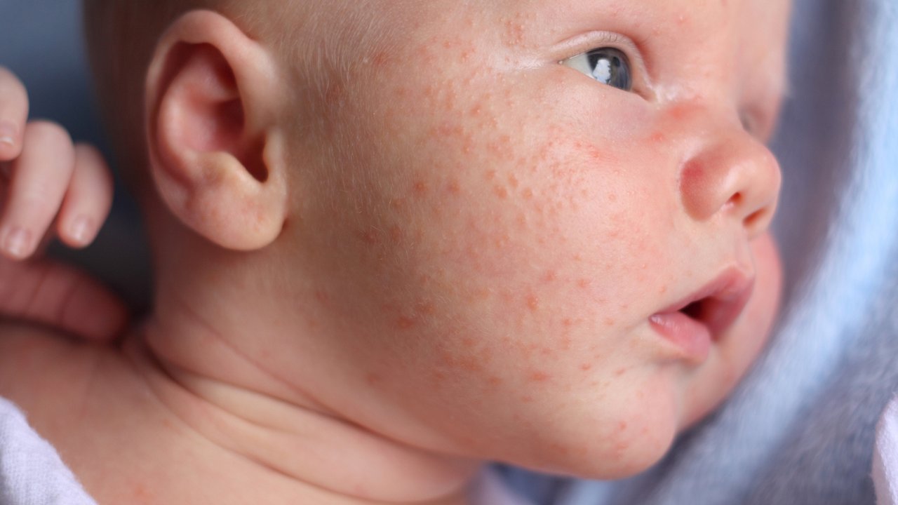 Neugeborenenakne: Wie lange sie dauert und was du dagegen tun kannst