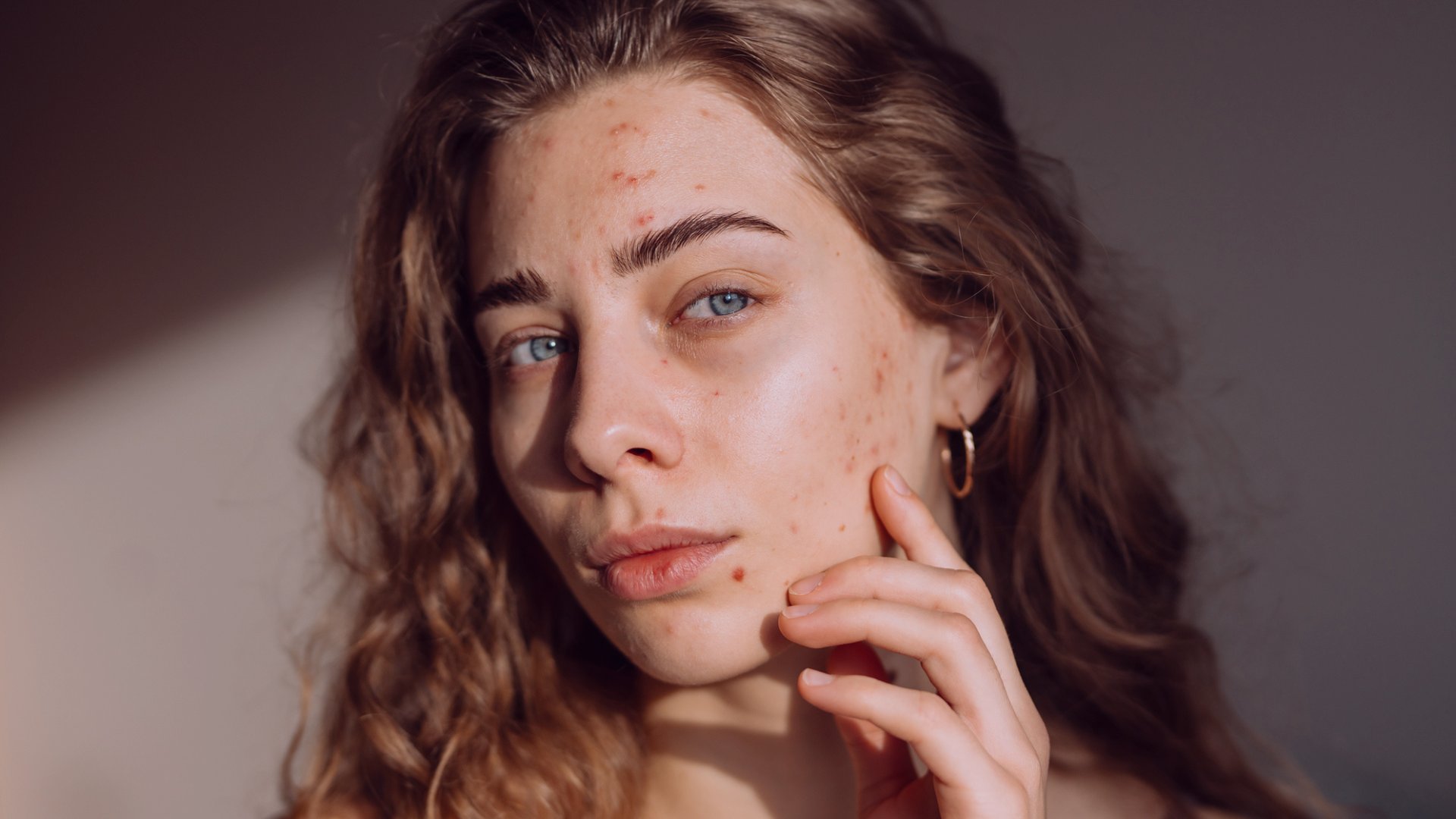 Aknenarben-Behandlung: Was hilft am besten?