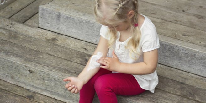 Die Nesselsucht – rote Quaddeln auf der Haut | desired.de