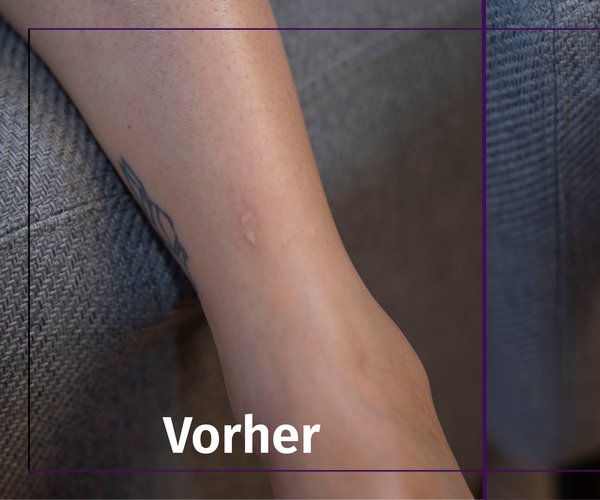 Große Pickel? So wirst du sie schneller los – ohne Narben!