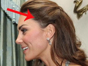 Darum hat Herzogin Kate eine riesige Narbe am Kopf